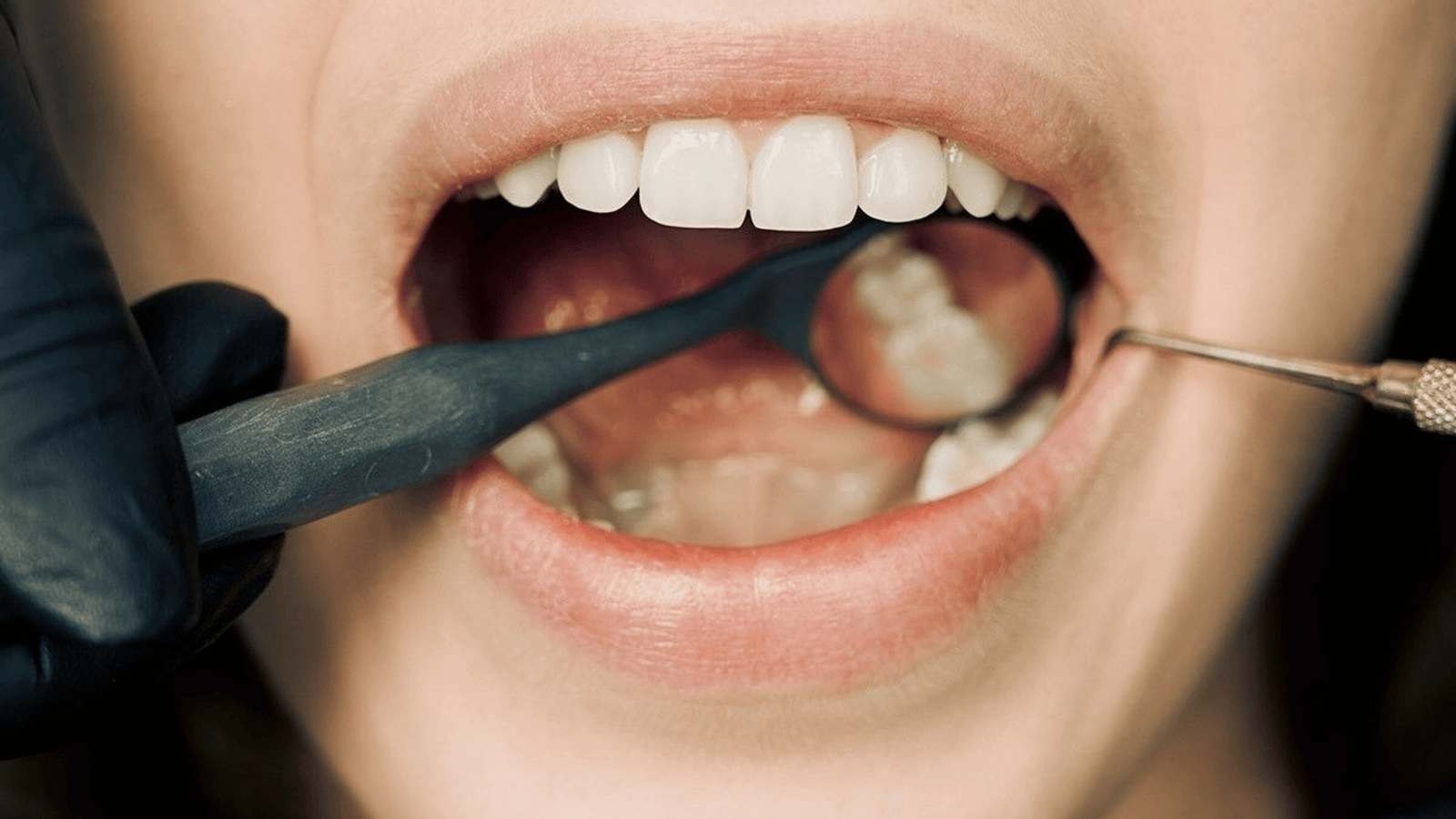 Dentes supranumerários: o que fazer quando surgem dentes a mais na boca ...